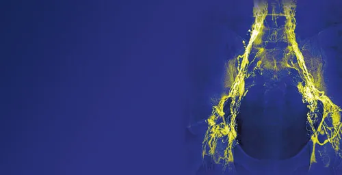 Lipiodol® (Ethiodized Oil) Injection | Guerbet